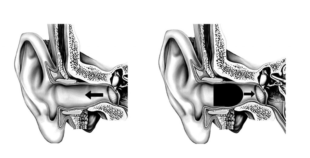 Appareil auditif invisible : l’insertion profonde dans le conduit ...